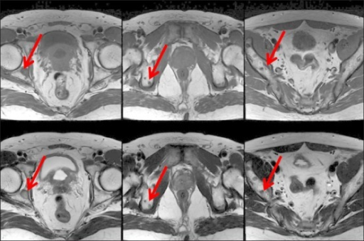 Axial T1 And T2 Weighted Mri Of The Pelvis Reveals Mul Open I