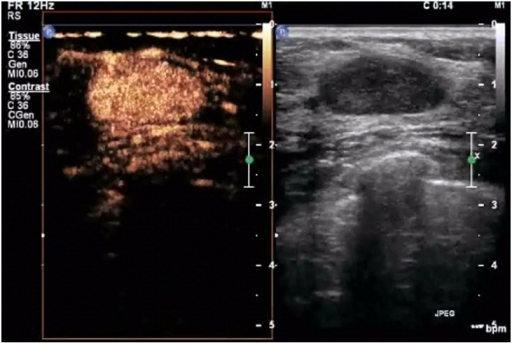 A Lesion With A Score Of 3 By Breast Contrast Enhanced Open I