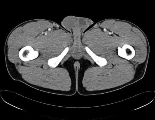 The Ct Image Shows The Presence Of Inguinal Lymph Nodes Open I