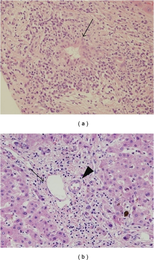 Primary Biliary Cirrhosis Pbc A Chronic Nonsuppura Open I
