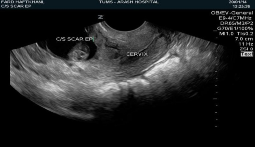 Cesarean Scar Pregnancy Demonstrated By Transvaginal So Open I
