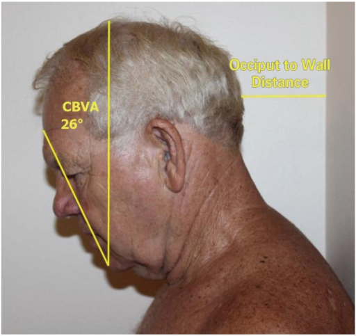 Clinical Photograph Showing The Measurement Of Chin Bro Open I