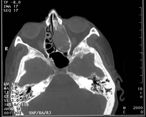 Axial Ct Scan Of The Nose And Paranasal Sinuses Showing Open I