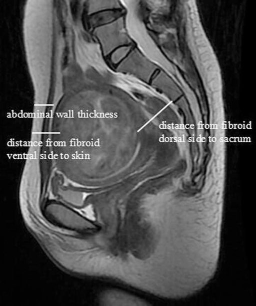Measurement Of Distance From Uterine Fibroid Ventral Si Open I