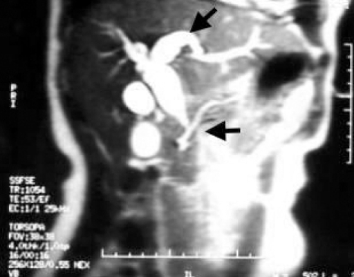 Mri Showing Intrahepatic Bile Duct Dilation And A Long Open I