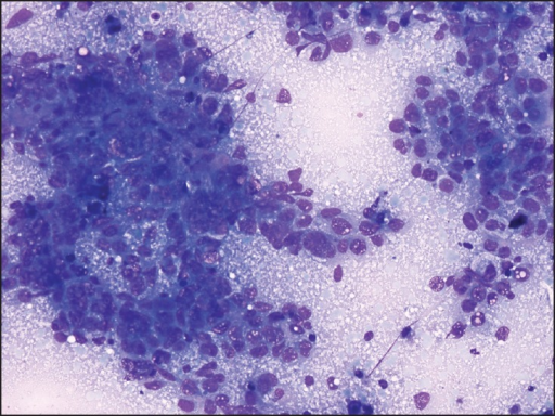 Fine Needle Aspiration Cytology Smears From Mediastinal Open I
