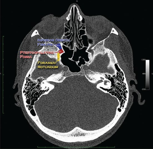 Ct Scan Bone Window Axial Section Through The Uppermost Portion Of