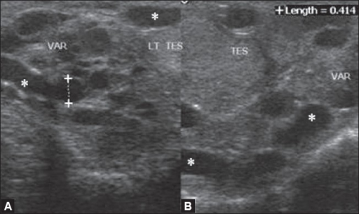 Varicoceles Usg Shows Multiple Dilated Tortuous Anecho Open I