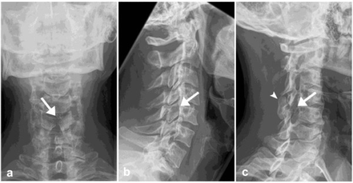 A C Plain Radiographs Of The Cervical Spine Antero Po Open I