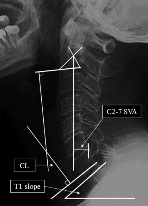 C2 7 Sagittal Vertical Axis C2 7 Sva Cervical Lordos Open I