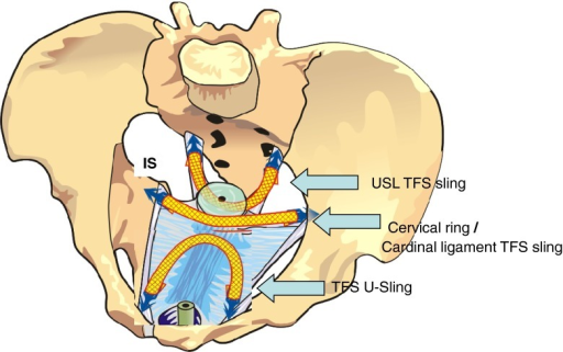 Tfs For Pelvic Organ Prolapse Pop Cervical Ring Card Open I