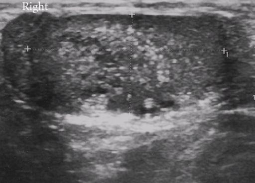 Scrotal Ultrasound Showing Multiple Small Cystic Lesion Open I